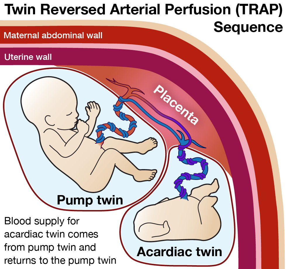 HỘI CHỨNG BƠM MÁU ĐỘNG MẠCH ĐẢO NGƯỢC( Twin-reversed arterial perfusion ...